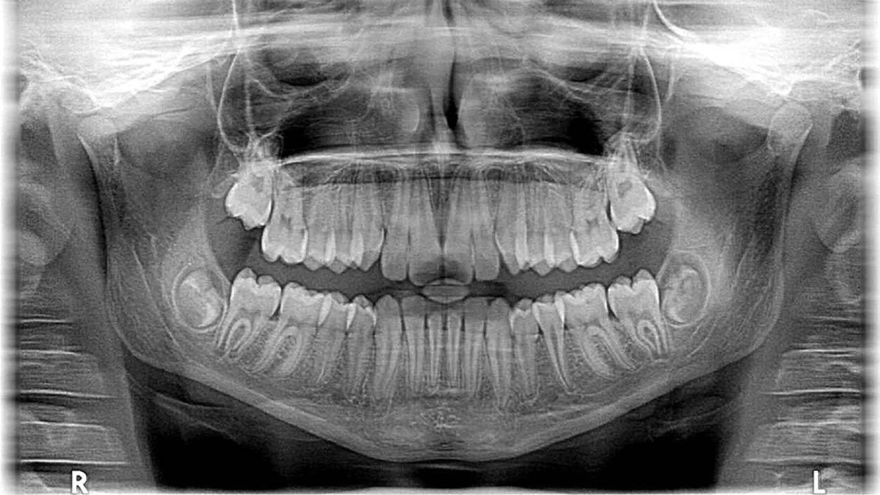 Tandarts laks met röntgenfoto's kindergebit - Kassa - BNNVARA